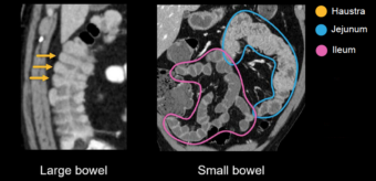 Abdominal CT: large intestine • LITFL • Radiology Library
