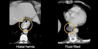 Abdominal CT: oesophagus and stomach • LITFL • Radiology