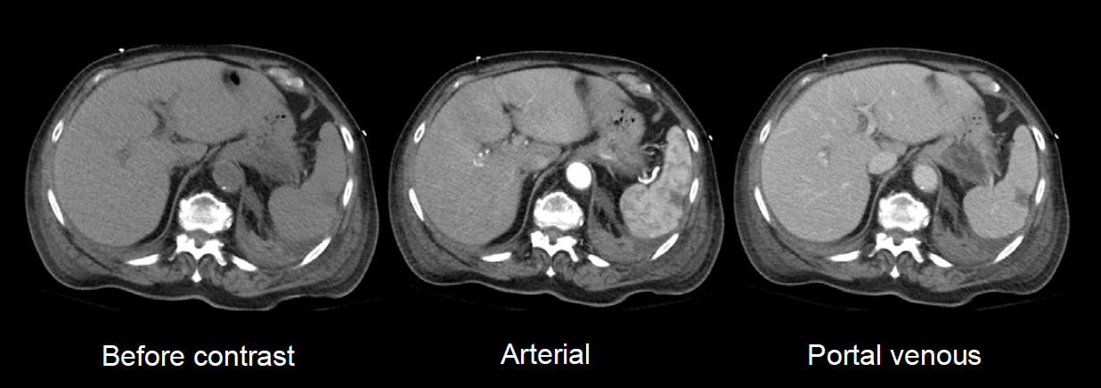 Abdominal CT: Phases • LITFL • Radiology library