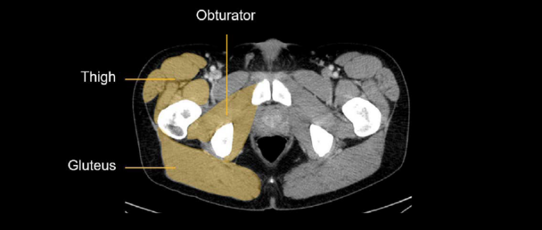 Abdominal CT Body Wall LITFL Radiology Library Abdominal CT Body Wall LITFL Radiology Library