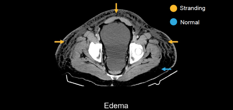 Abdominal CT: body wall • LITFL • Radiology Library