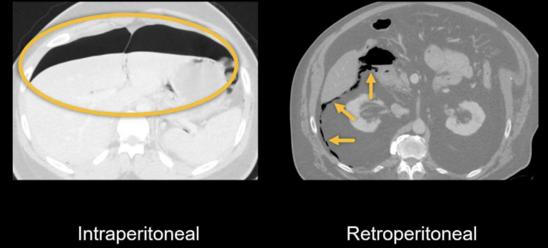 Abdominal CT: peptic ulcer perforation • LITFL • Radiology Library