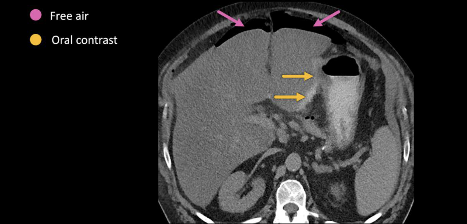 Abdominal CT: peptic ulcer perforation • LITFL • Radiology Library