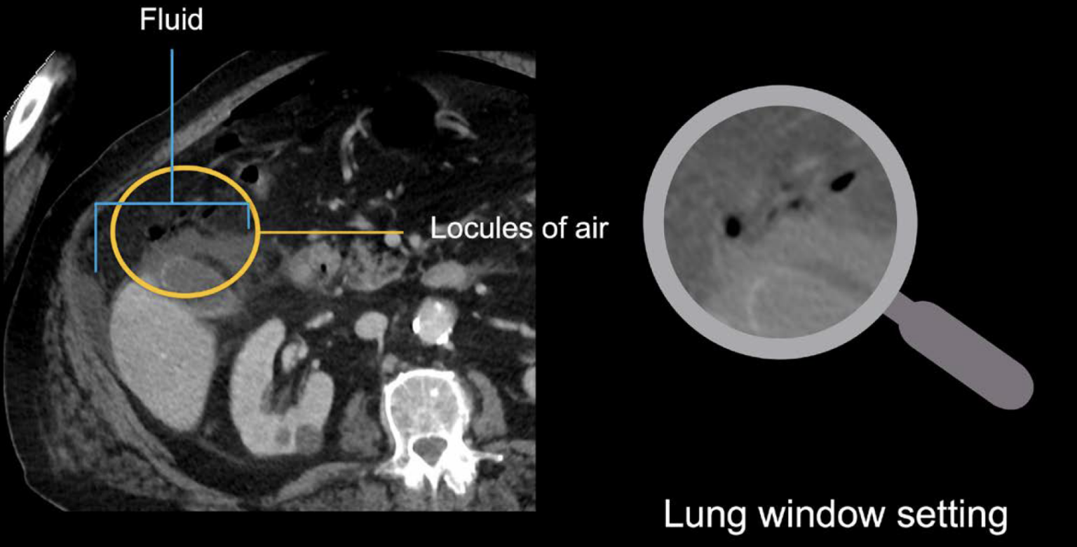 Abdominal CT: peptic ulcer perforation • LITFL • Radiology Library
