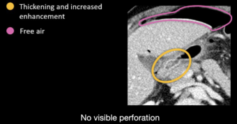 Abdominal CT: peptic ulcer perforation • LITFL • Radiology Library