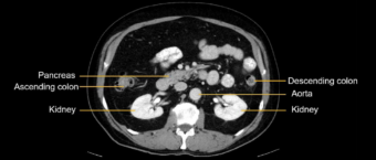 Abdominal CT: peritoneal cavity • LITFL • Radiology Library