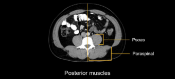 Abdominal CT: body wall • LITFL • Radiology Library