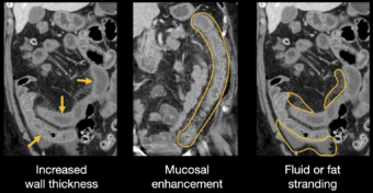 Abdominal CT: enteritis and colitis • LITFL • Radiology Library