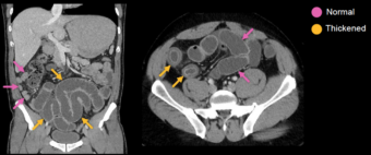 Abdominal CT: small intestine • LITFL • Radiology Library