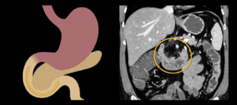 Abdominal CT: small intestine • LITFL • Radiology Library
