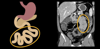 Abdominal CT: small intestine • LITFL • Radiology Library