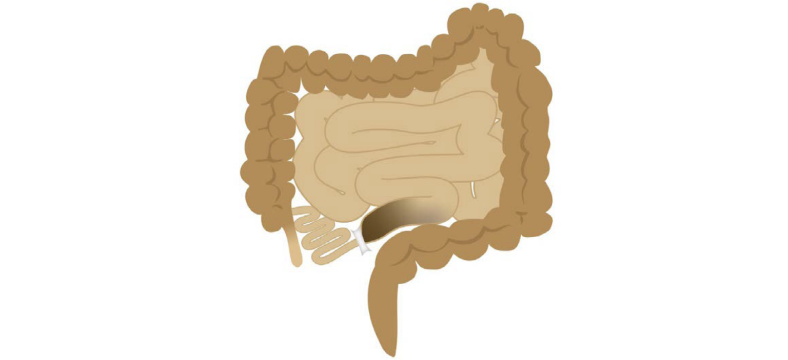 Abdominal CT: small bowel obstruction • LITFL • Radiology Library