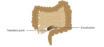 Abdominal CT: small bowel obstruction • LITFL • Radiology Library