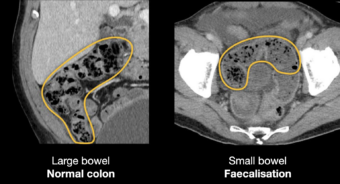 Abdominal CT: small bowel obstruction • LITFL • Radiology Library