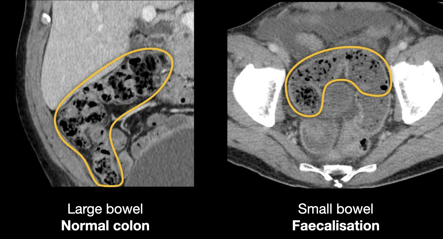 Small Bowel Obstruction Air Fluid Levels
