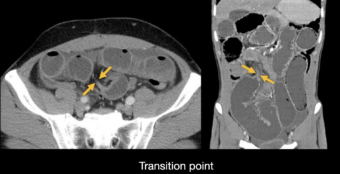 Abdominal CT: small bowel obstruction • LITFL • Radiology Library