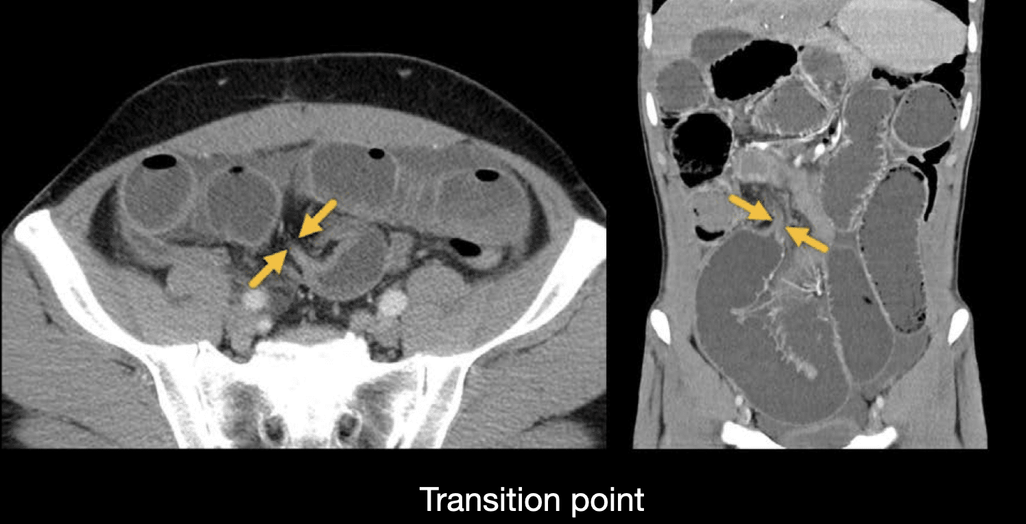 Small Bowel Obstruction Small Bowel Obstruction