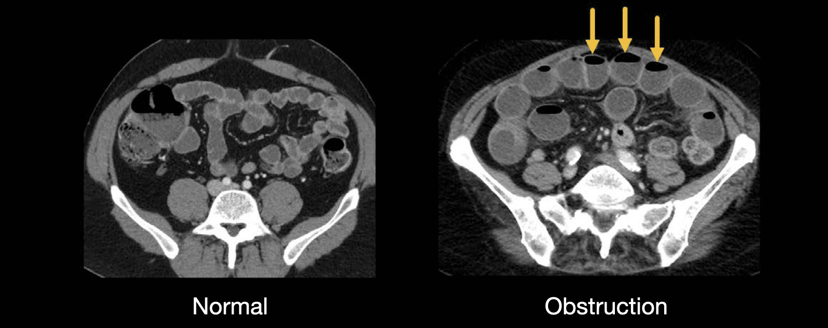 Small Bowel Small Bowel