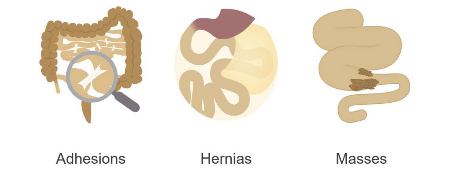 Abdominal CT: small bowel obstruction • LITFL • Radiology Library