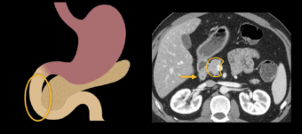 Abdominal CT: small intestine • LITFL • Radiology Library