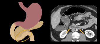 Abdominal CT: small intestine • LITFL • Radiology Library