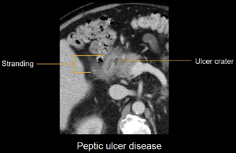Abdominal CT: oesophagus and stomach • LITFL • Radiology
