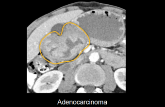 Abdominal CT: oesophagus and stomach • LITFL • Radiology