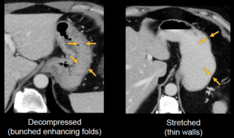 Abdominal CT: oesophagus and stomach • LITFL • Radiology
