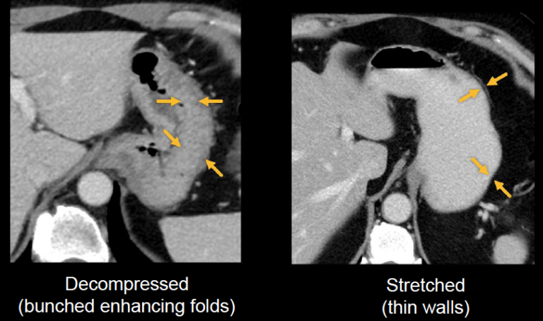 Abdominal CT: oesophagus and stomach • LITFL • Radiology