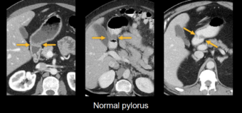 Abdominal CT: oesophagus and stomach • LITFL • Radiology