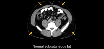 Abdominal CT: body wall • LITFL • Radiology Library