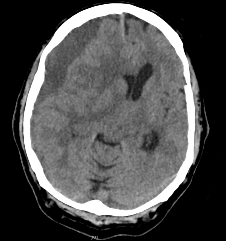 CT Case 013 • LITFL • CT scan interpretation