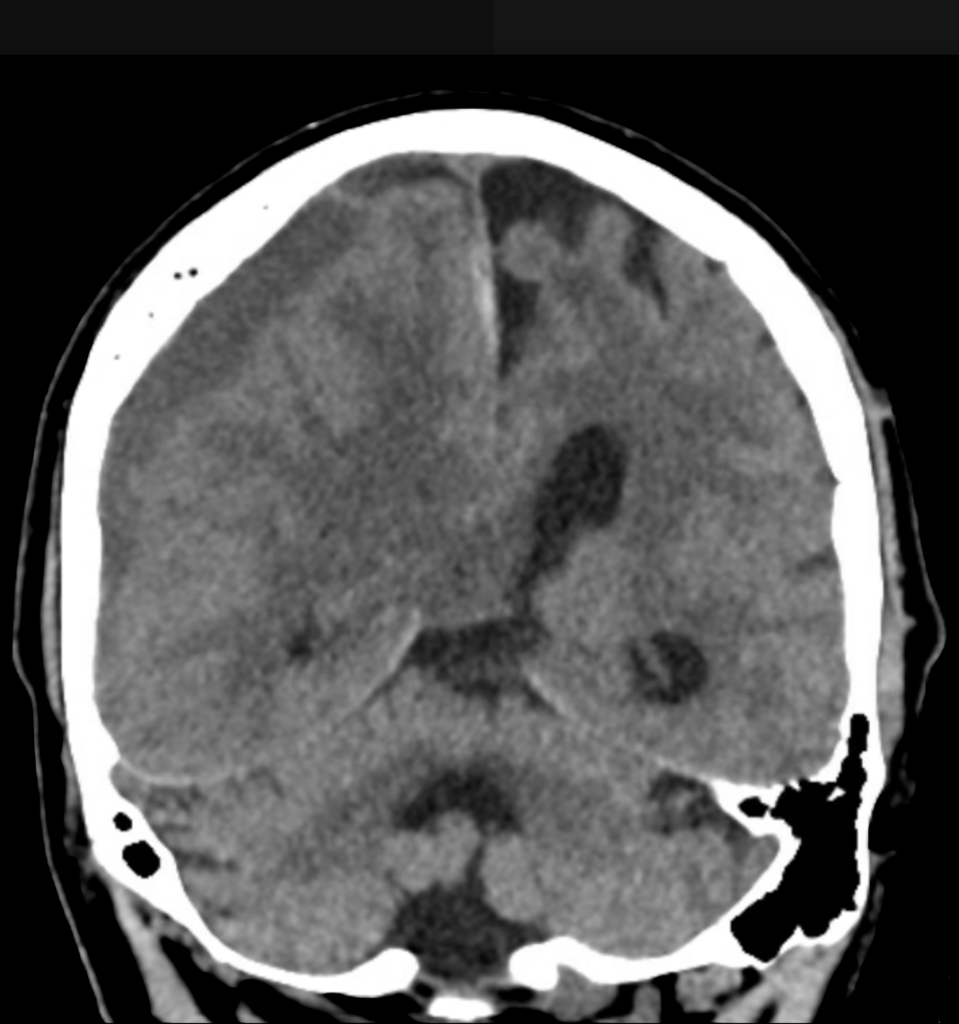 CT Case 013 • LITFL • CT scan interpretation