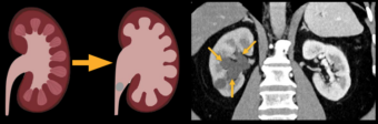 Abdominal CT: Flank pain • LITFL • Radiology library
