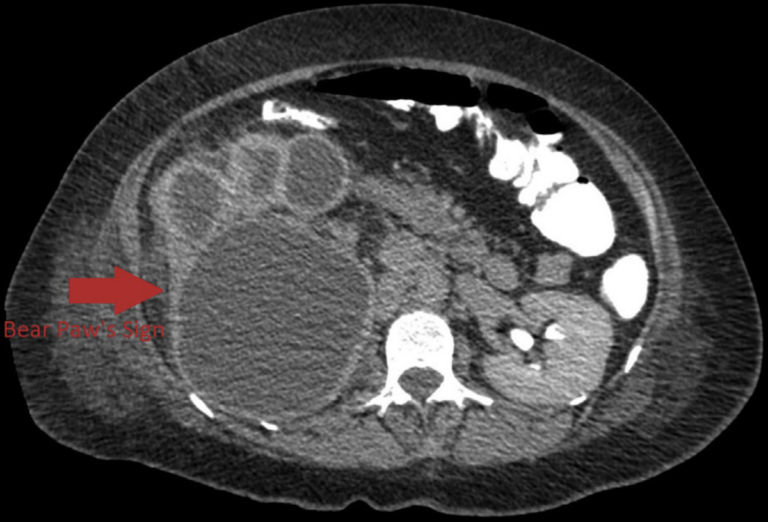 CT Case 014 • LITFL • CT scan interpretation