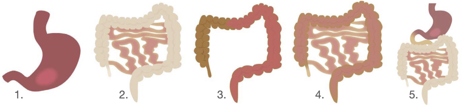 Abdominal CT: enteritis and colitis • LITFL • Radiology Library