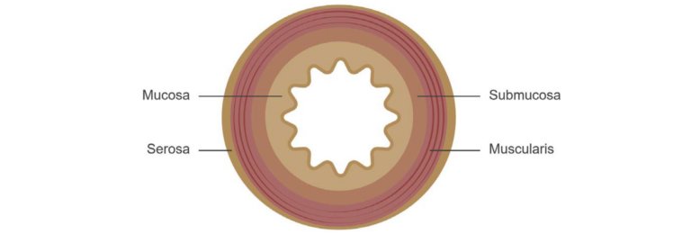 Abdominal CT: enteritis and colitis • LITFL • Radiology Library