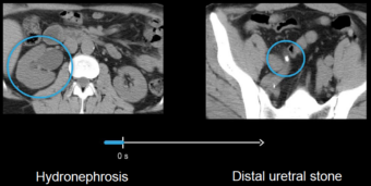 Abdominal CT: Flank pain • LITFL • Radiology library