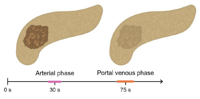 Abdominal CT: Cancer staging • LITFL • Radiology library