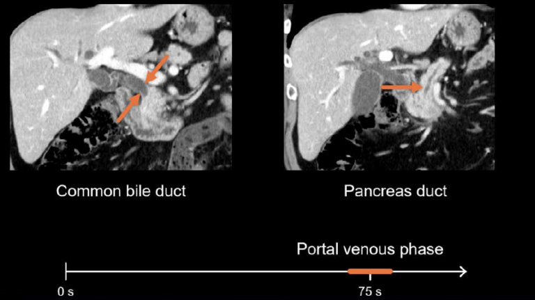 Abdominal CT: Cancer staging • LITFL • Radiology library