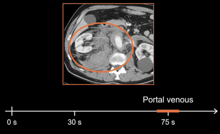 Abdominal CT: Phases • LITFL • Radiology library