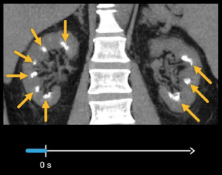 Abdominal CT: Flank pain • LITFL • Radiology library