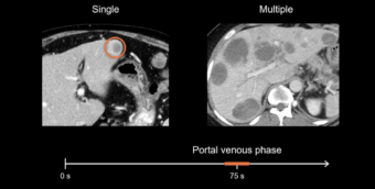 Abdominal CT: Cancer staging • LITFL • Radiology library