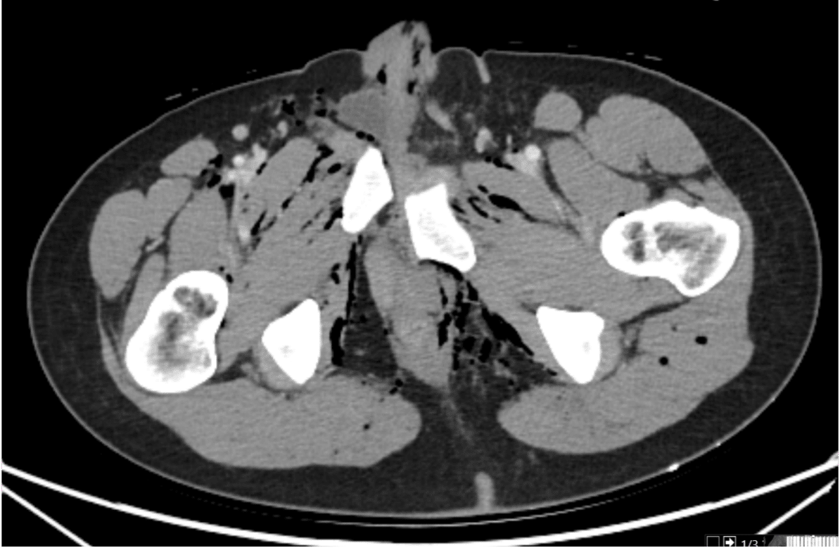 CT Case 053 • LITFL • CT scan interpretation