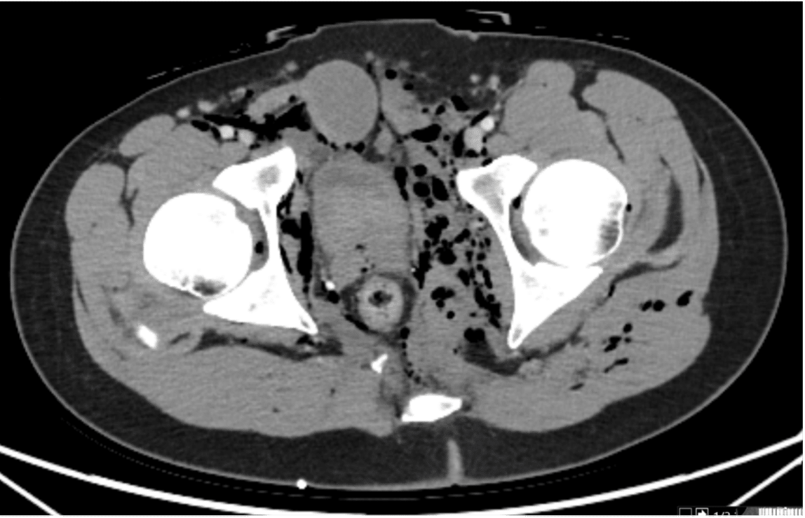 CT Case 053 • LITFL • CT scan interpretation