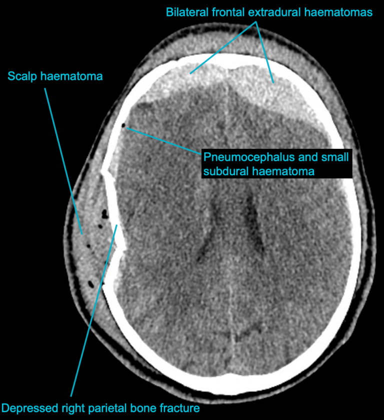 CT Case 054 • LITFL • CT scan interpretation