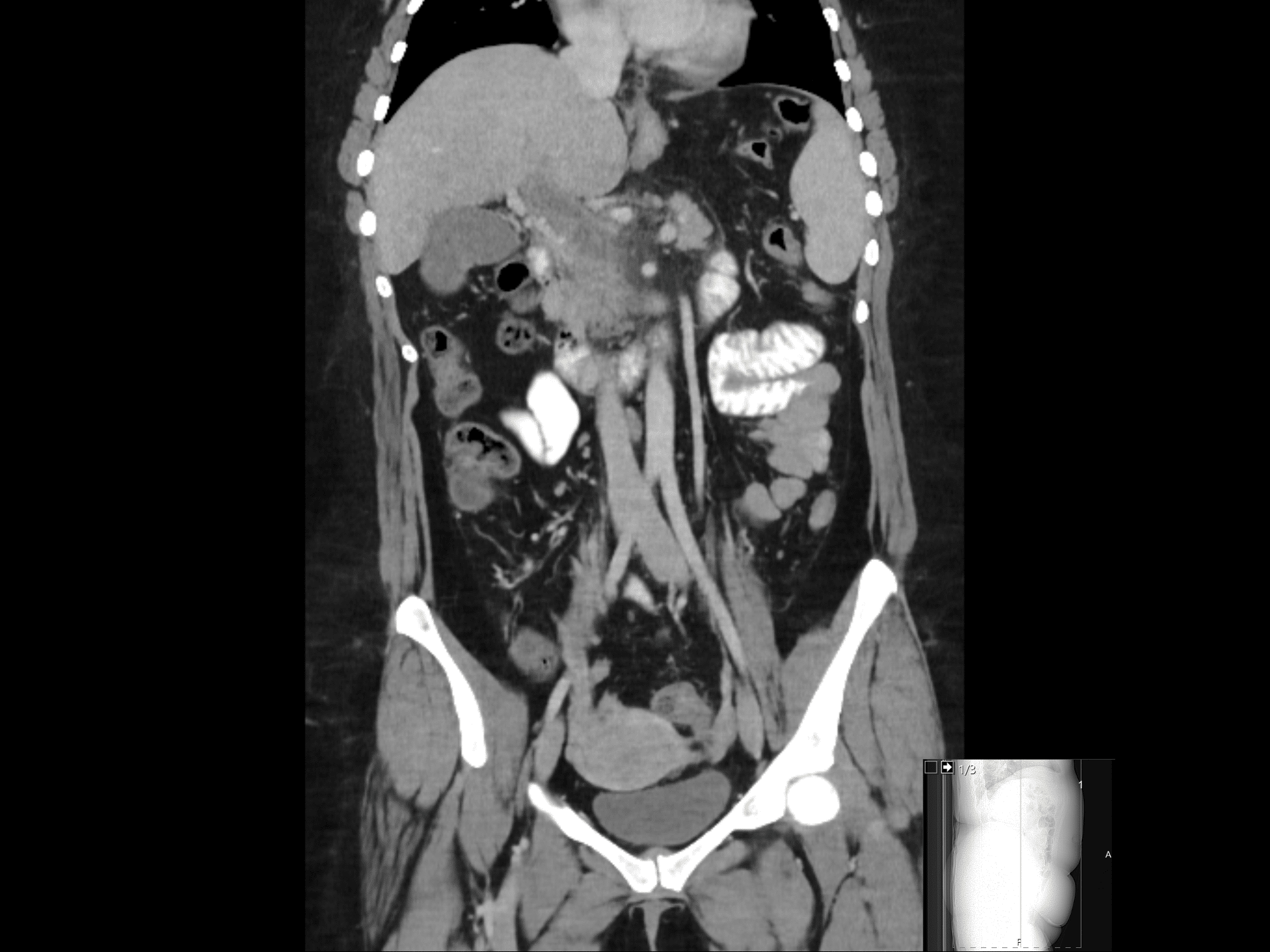 CT Case 058 • LITFL • CT scan interpretation