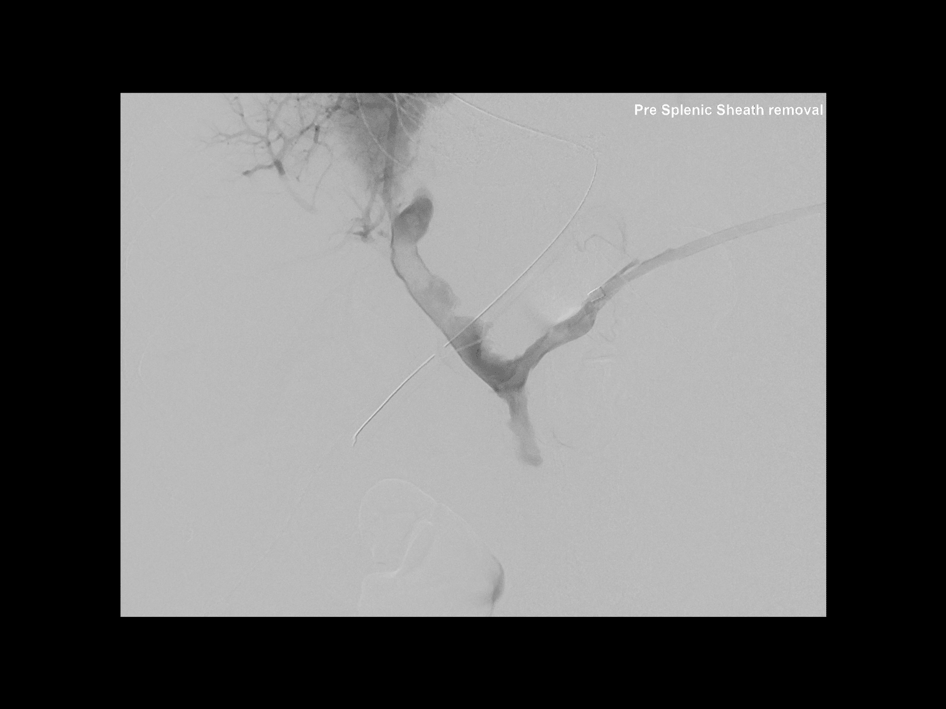 CT Case 058 • LITFL • CT scan interpretation