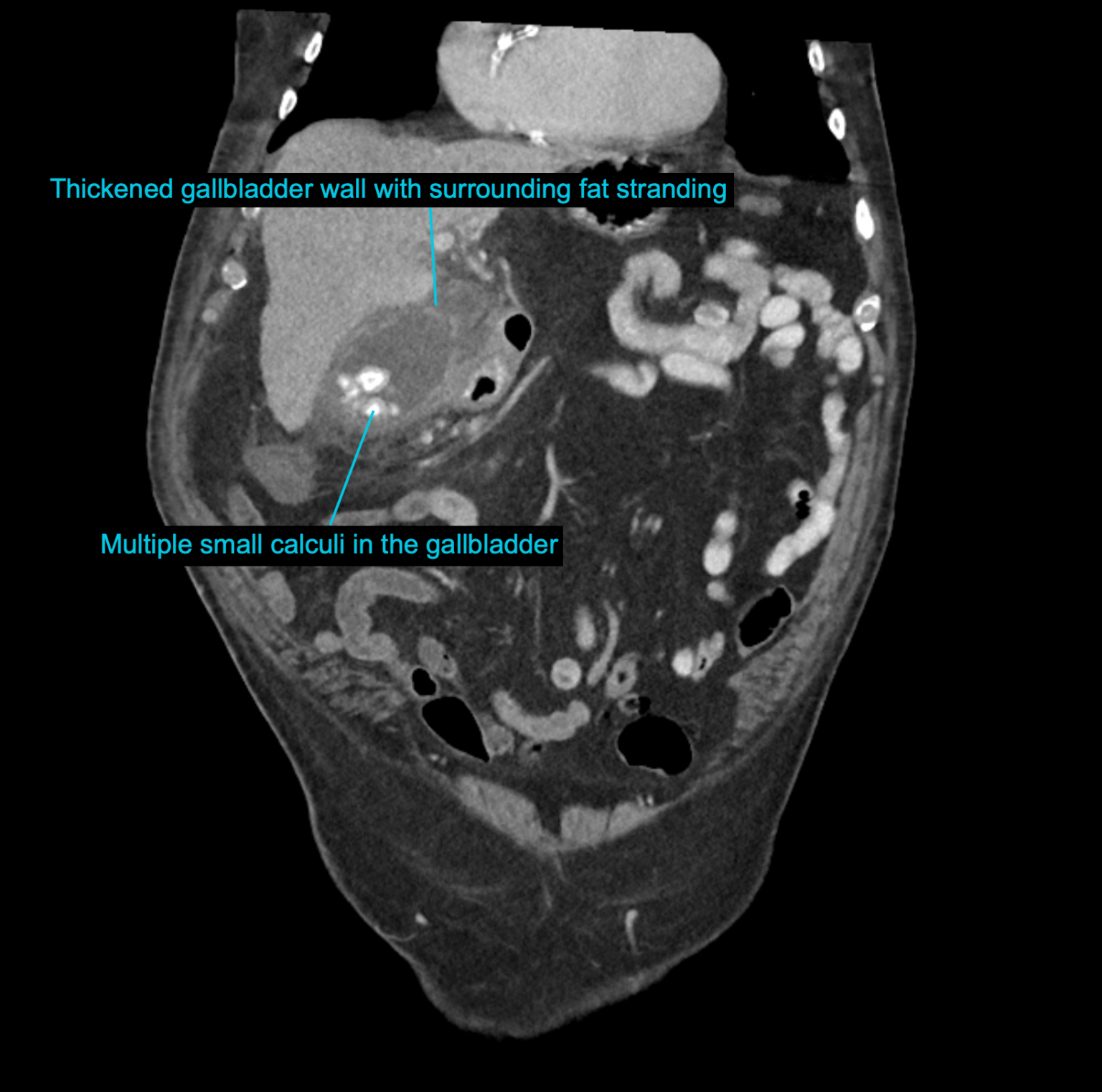 CT Case 059 • LITFL • CT scan interpretation