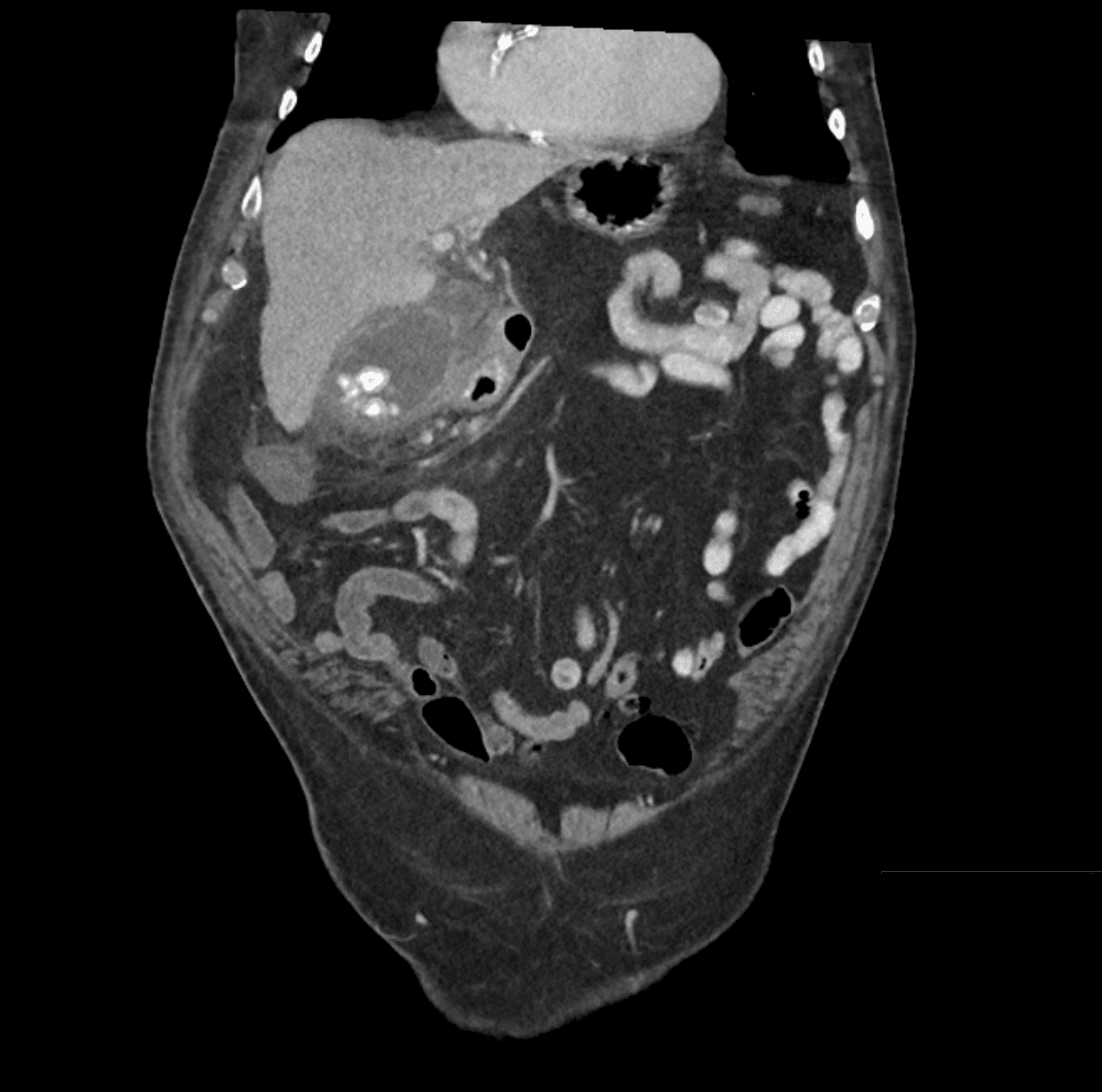 CT Case 059 • LITFL • CT scan interpretation